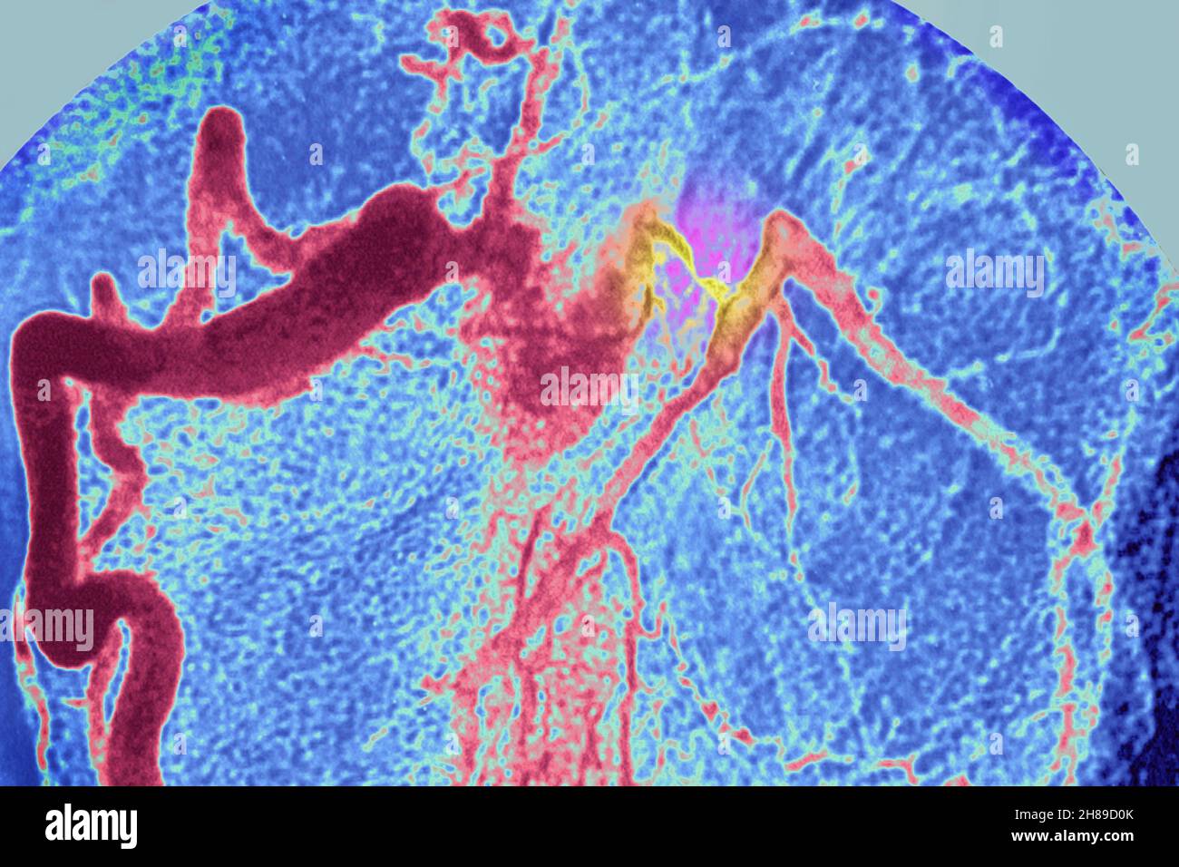 Infarction hi-res stock photography and images - Alamy