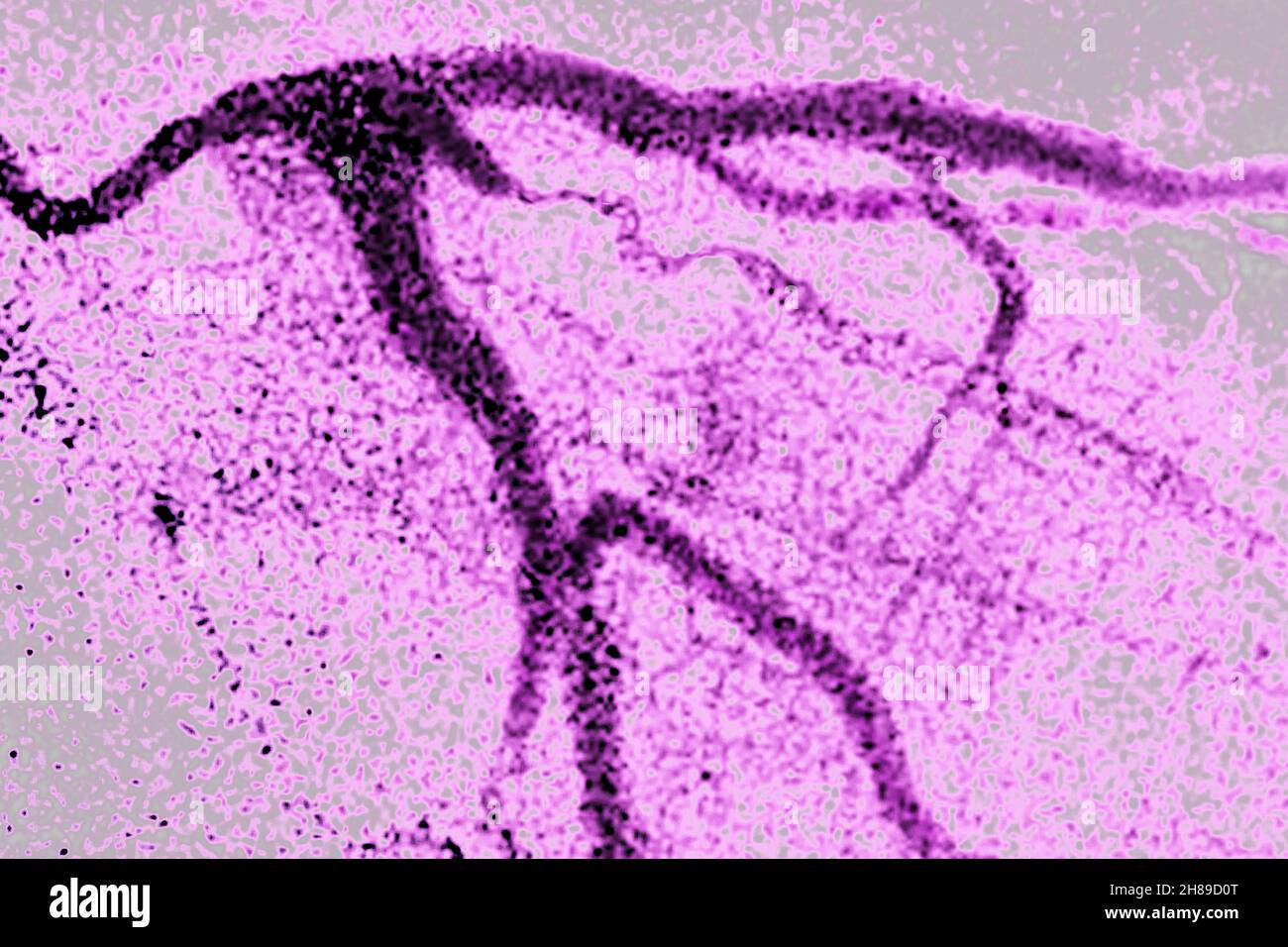 Infarction hi-res stock photography and images - Alamy