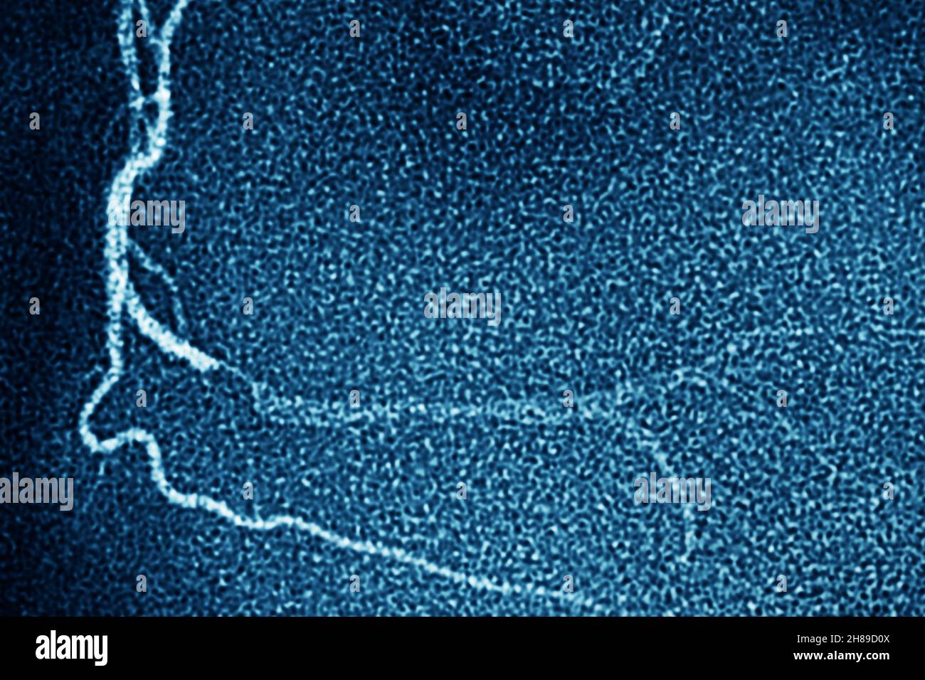 Coronary infarction hi-res stock photography and images - Alamy