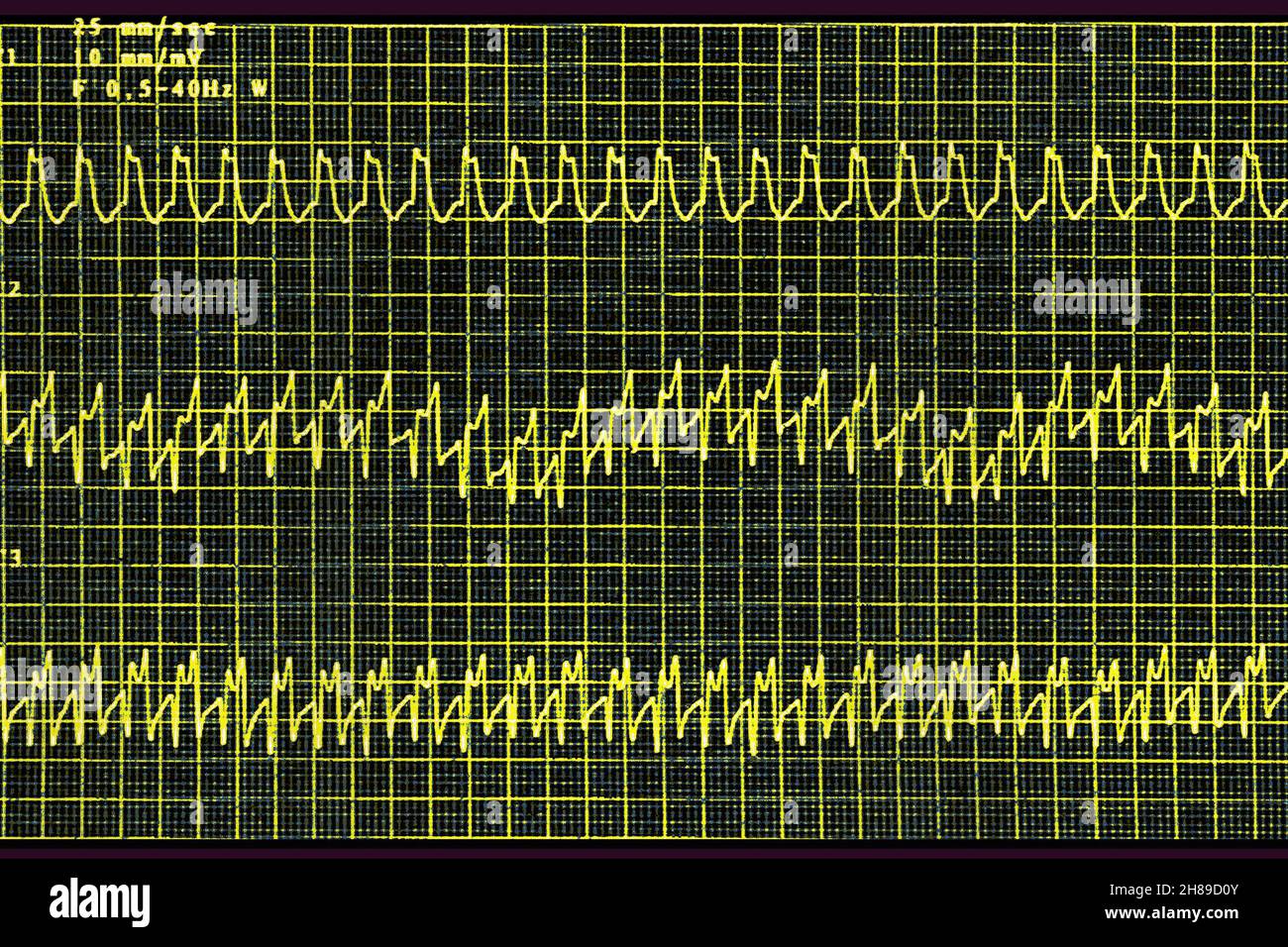 Atrial Fibrillation What Are The Different Types 50 Off