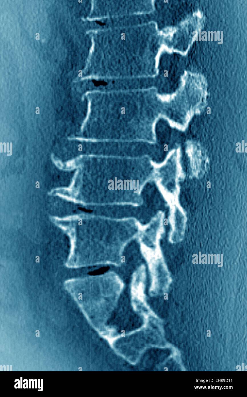 Lumbar degenerative disc disease Stock Photo - Alamy