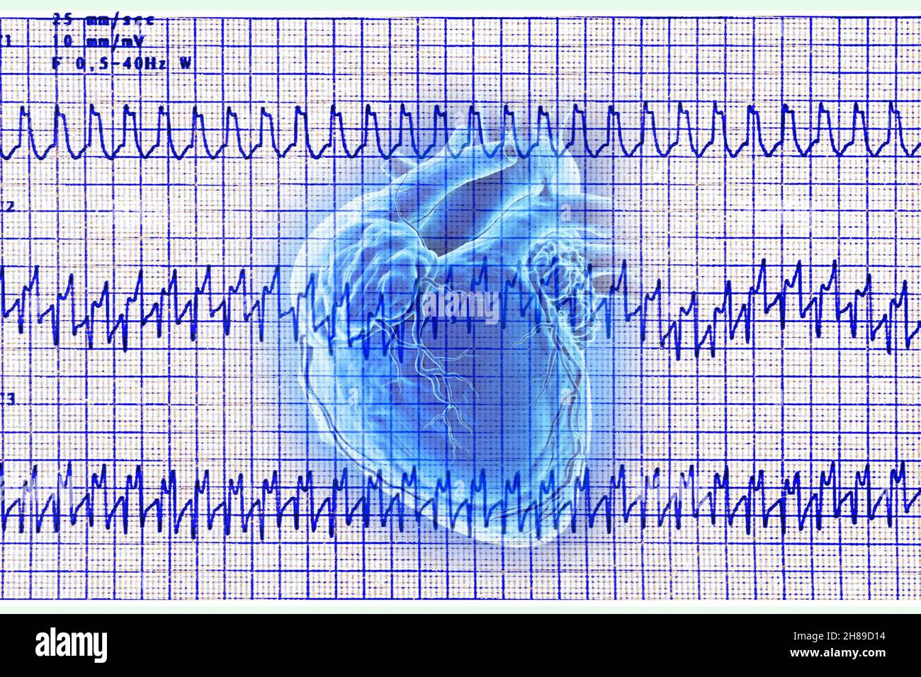 Atrial ecg hi-res stock photography and images - Alamy