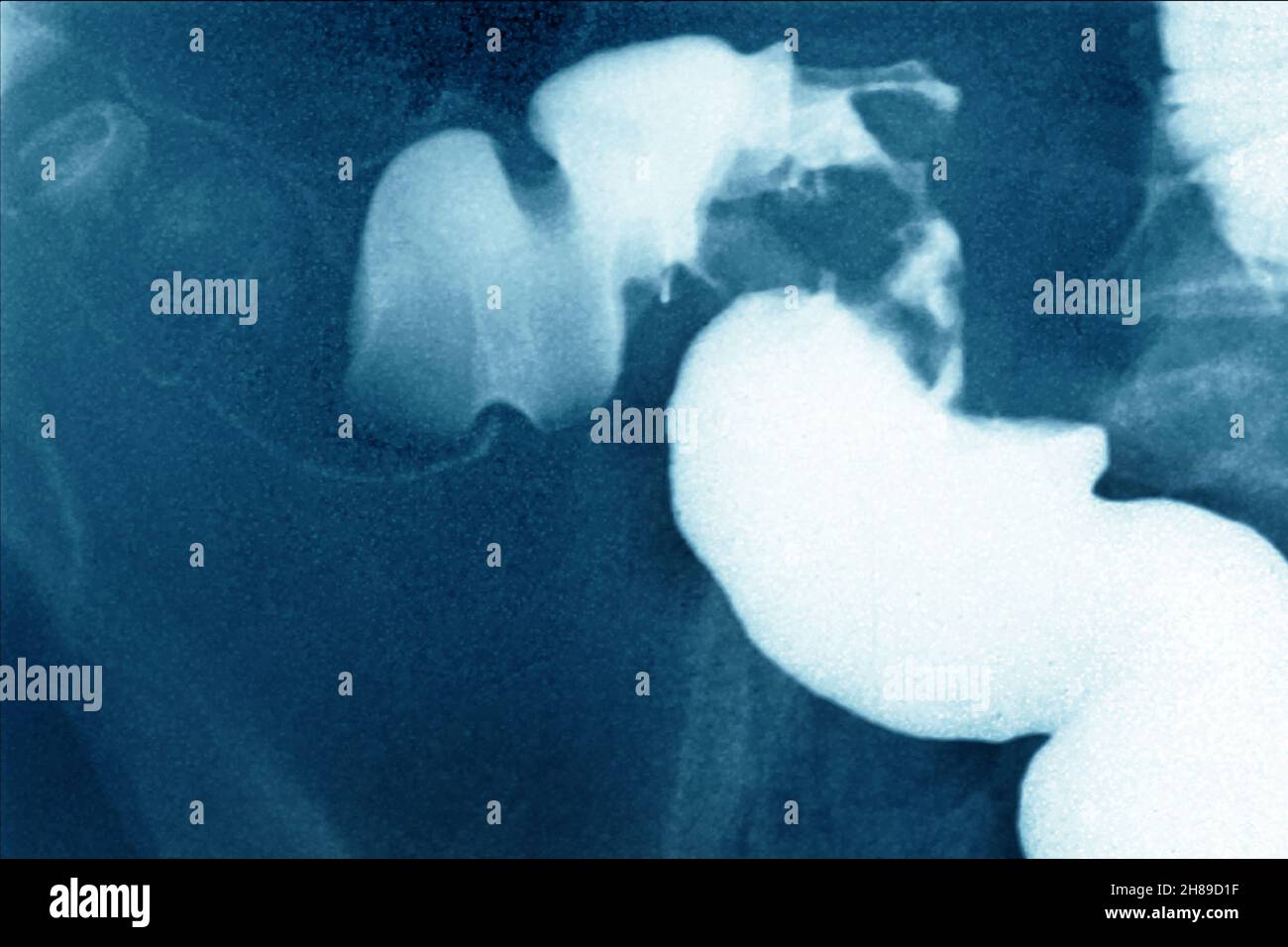 Scientific colorectal cancer hi-res stock photography and images - Alamy