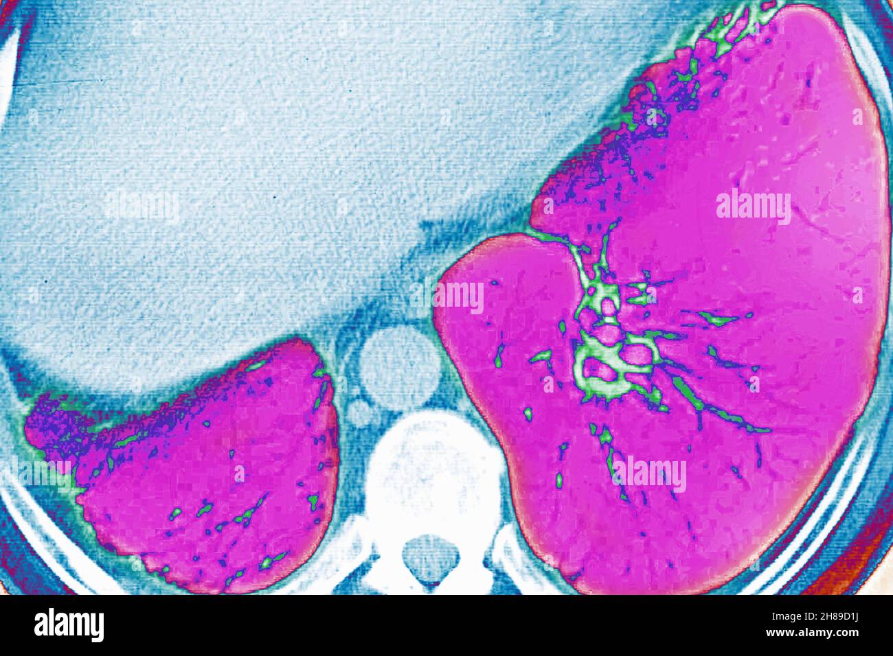 Abnormal mri hi-res stock photography and images - Alamy