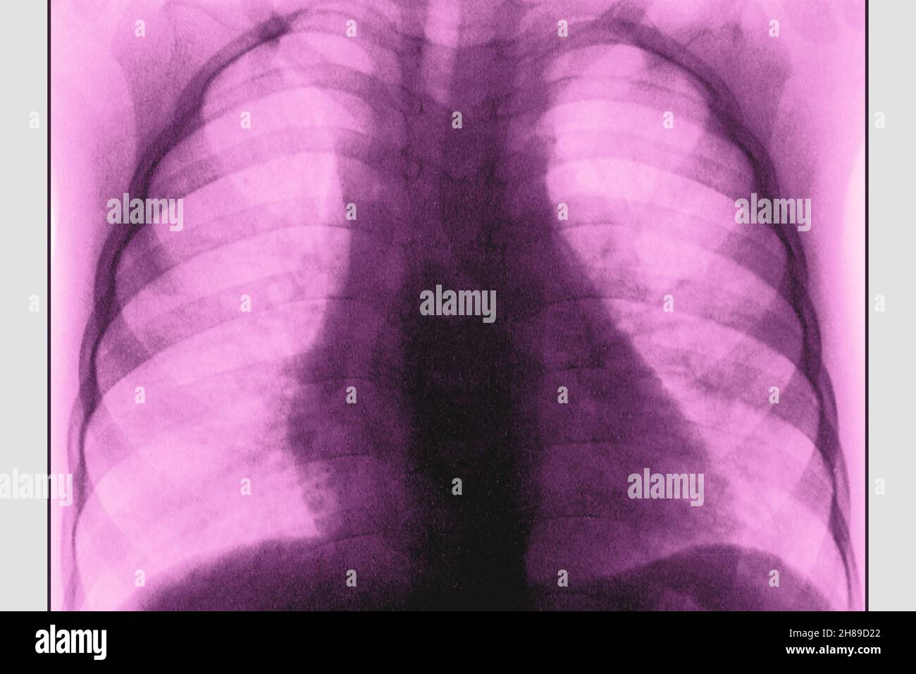 Pneumonia lung hi-res stock photography and images - Alamy