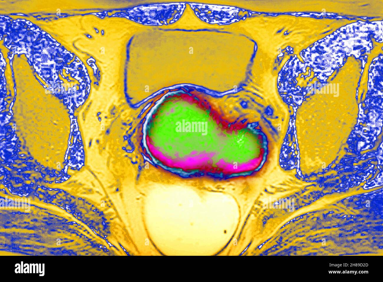 Uterine cancer mri hi-res stock photography and images - Alamy