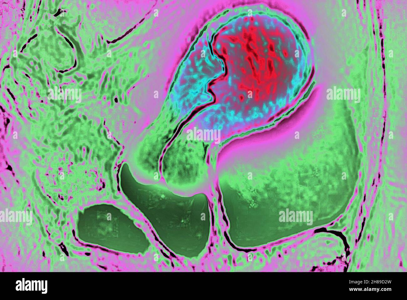 Uterine cancer mri hi-res stock photography and images - Alamy