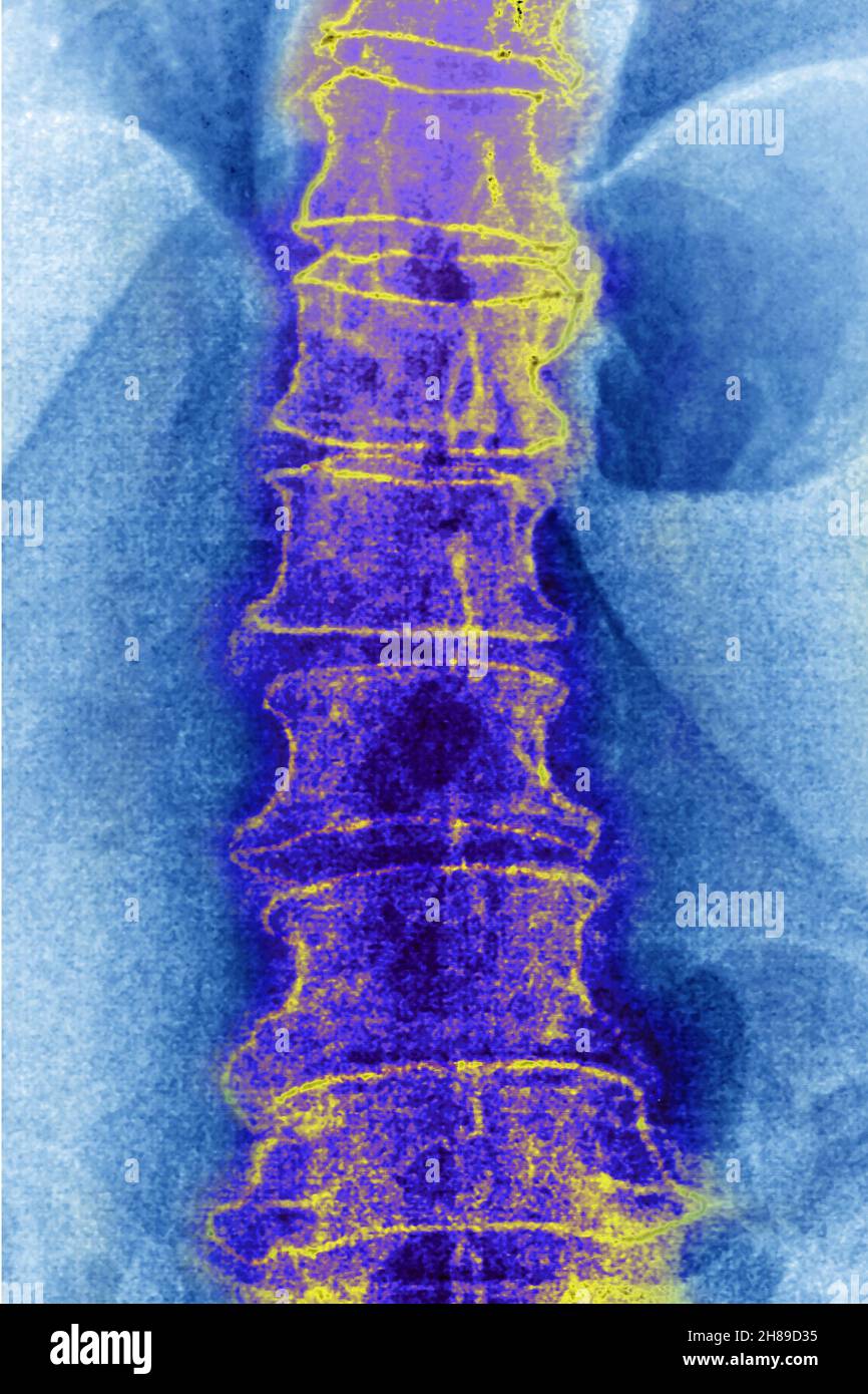 Lumbar degenerative disc disease Stock Photo - Alamy
