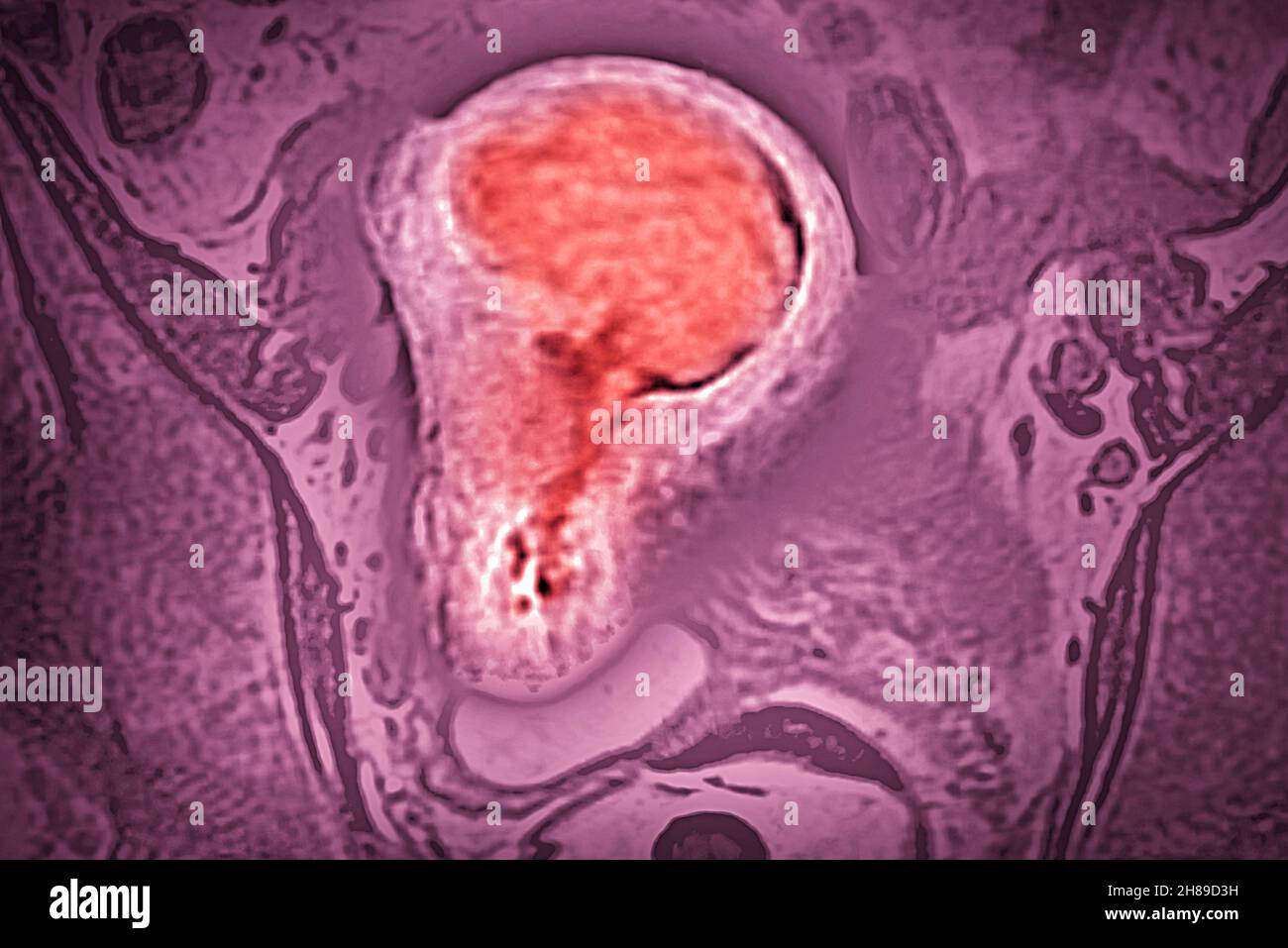 Uterine cancer mri hi-res stock photography and images - Alamy