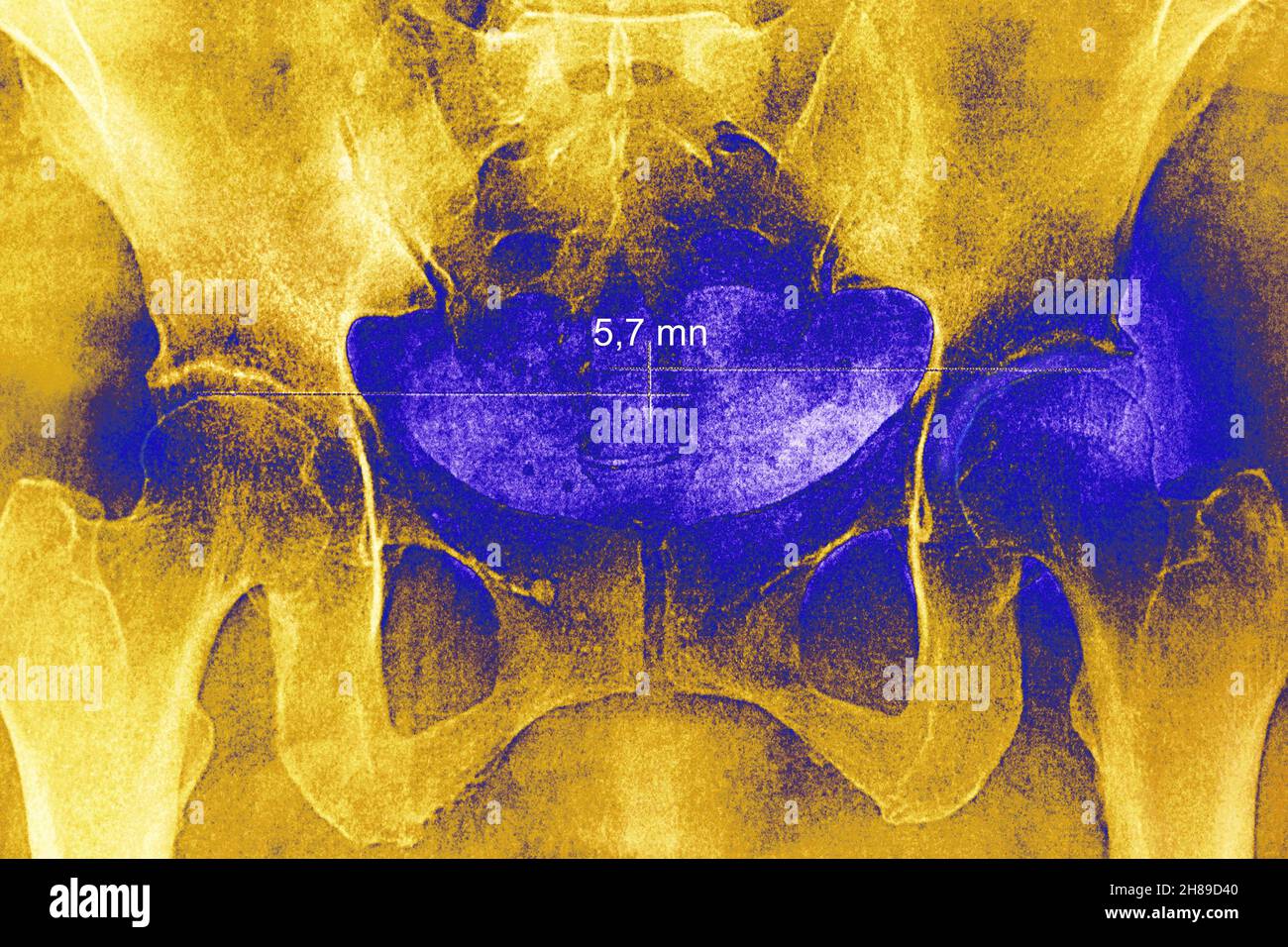 Hip and pelvis hi-res stock photography and images - Alamy