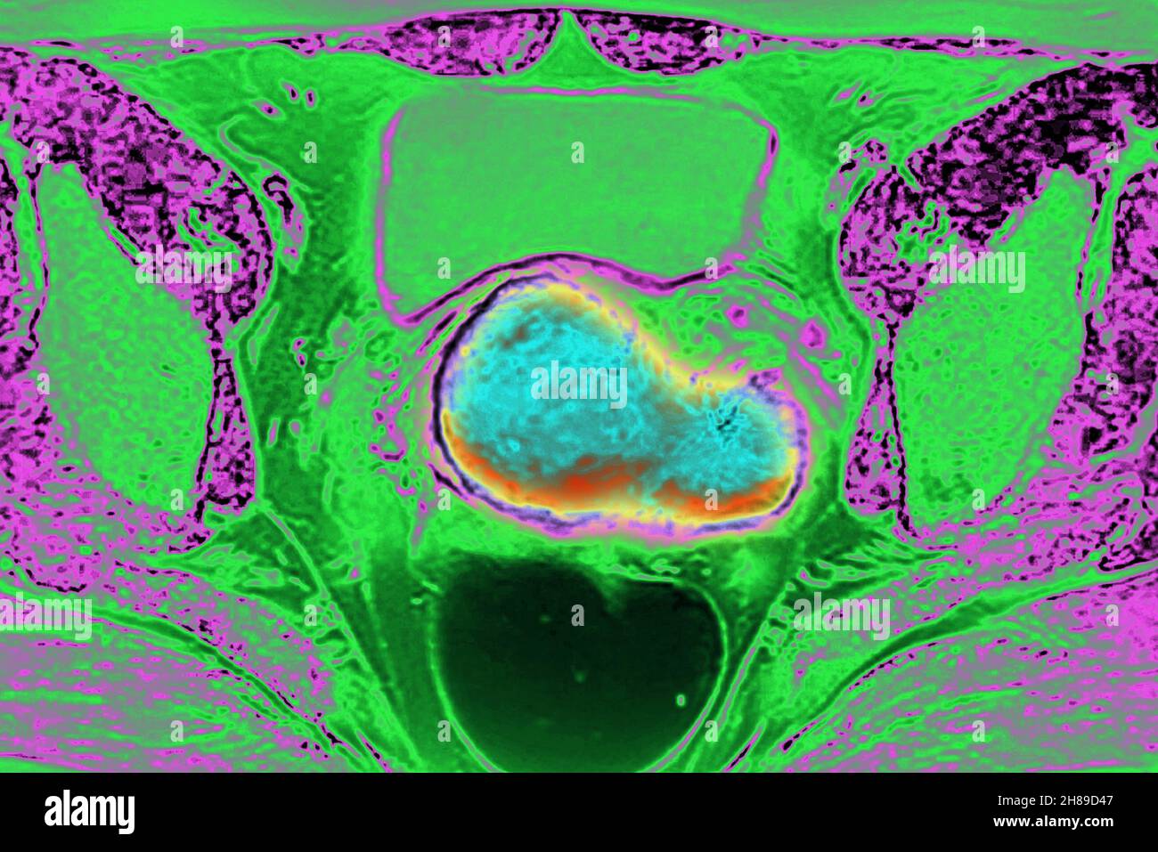 Uterine cancer mri hi-res stock photography and images - Alamy