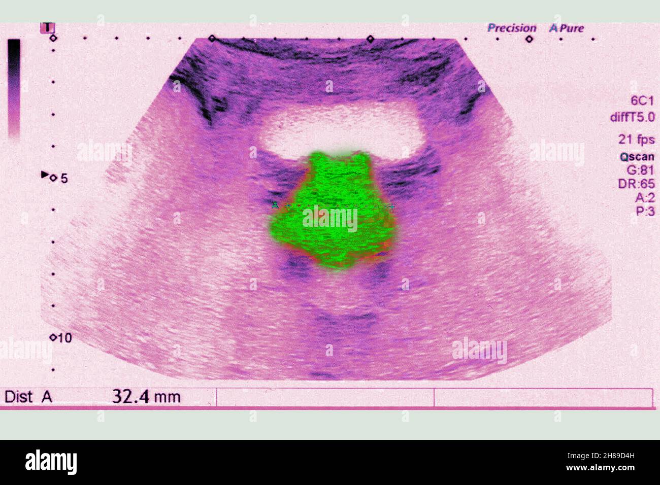 Ultrasound prostatic hi-res stock photography and images - Alamy