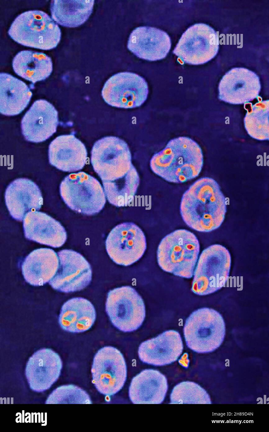 Plasmodium falciparum microscope hi-res stock photography and images ...