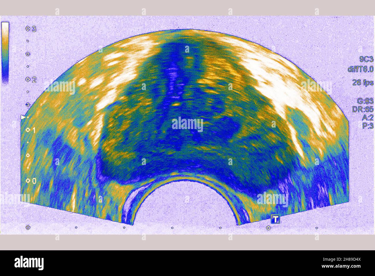 Sonography prostate hi-res stock photography and images - Alamy