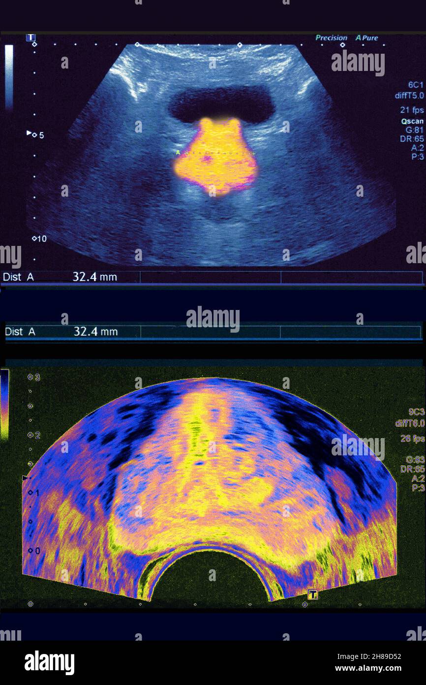Prostate cancer scan hi-res stock photography and images - Alamy