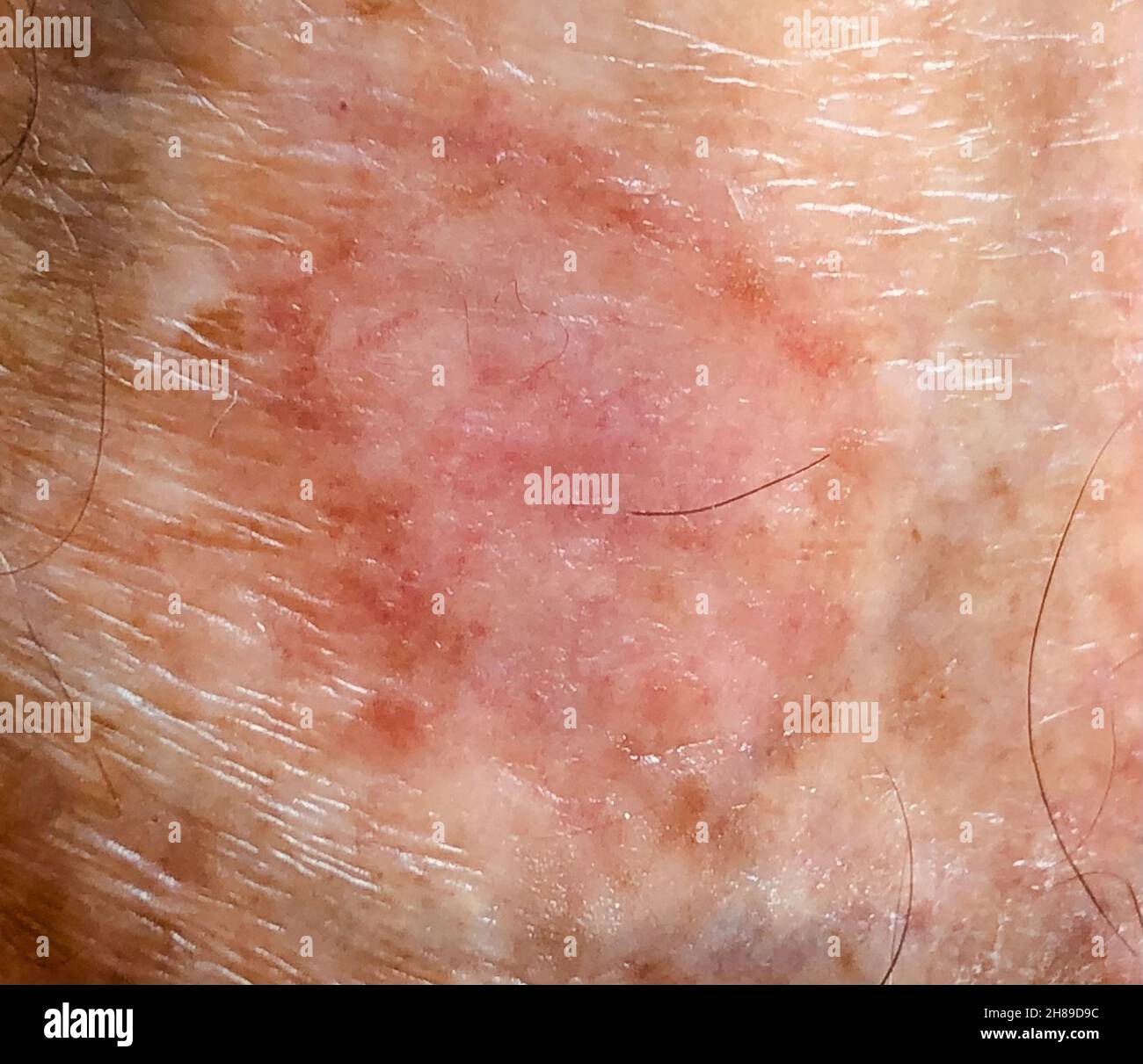 Yeast infection hi-res stock photography and images - Alamy