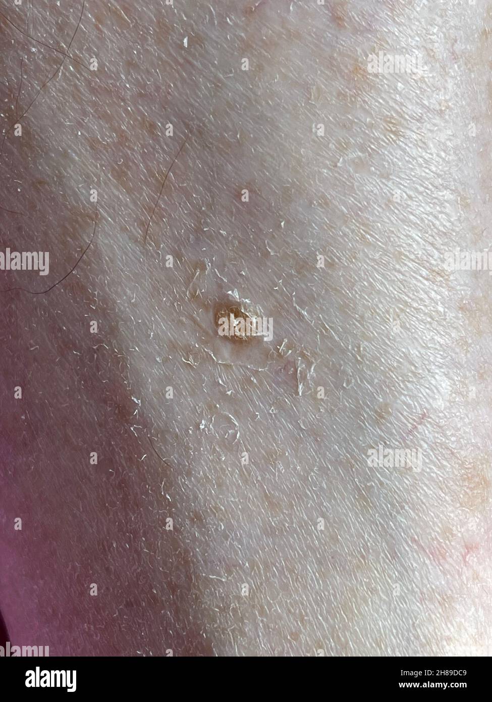 Psoriasis material hi-res stock photography and images - Alamy