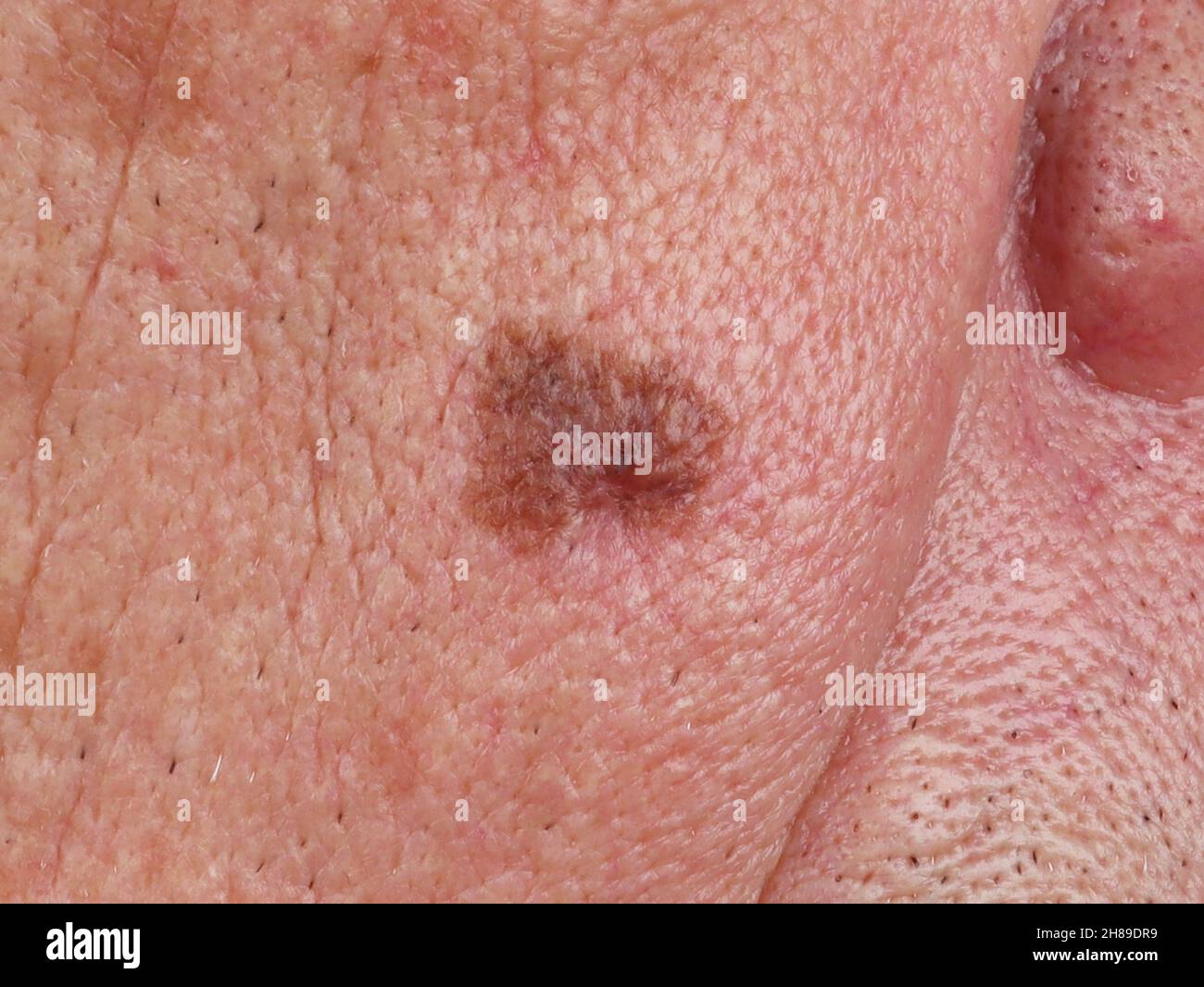 Melanoma face hi-res stock photography and images - Alamy