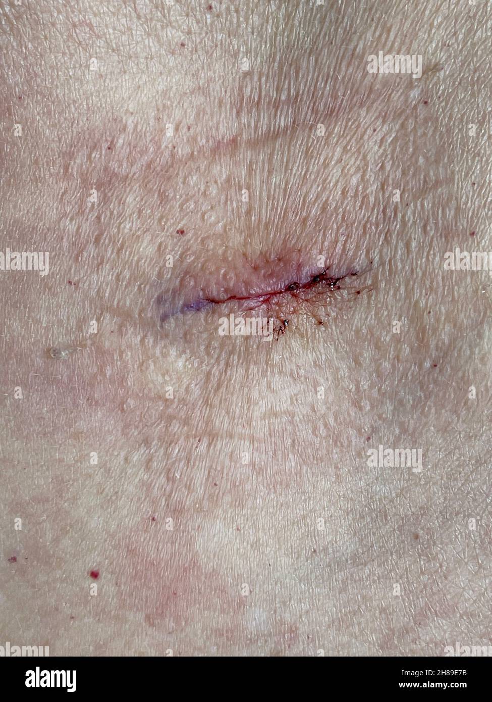 Removal of a cyst Stock Photo - Alamy