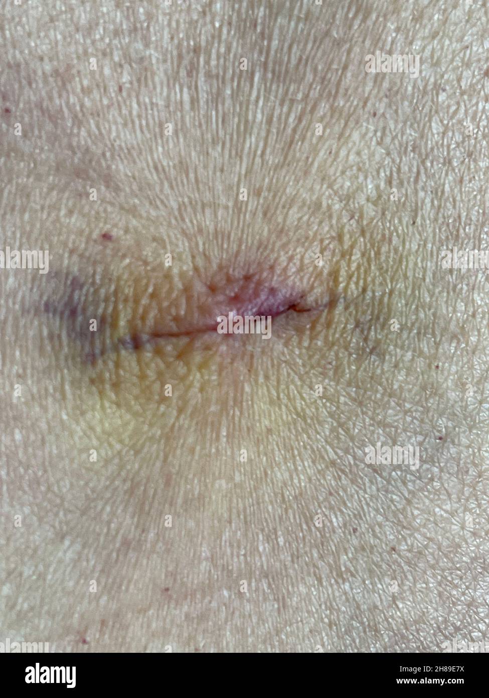 Excision hi-res stock photography and images - Alamy