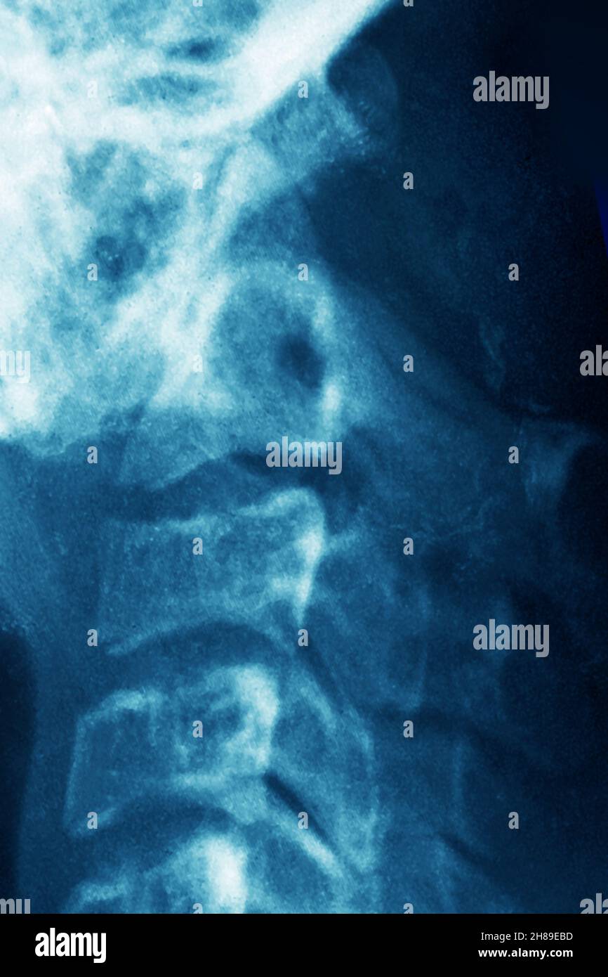 Dislocation of cervical vertebrae Stock Photo - Alamy