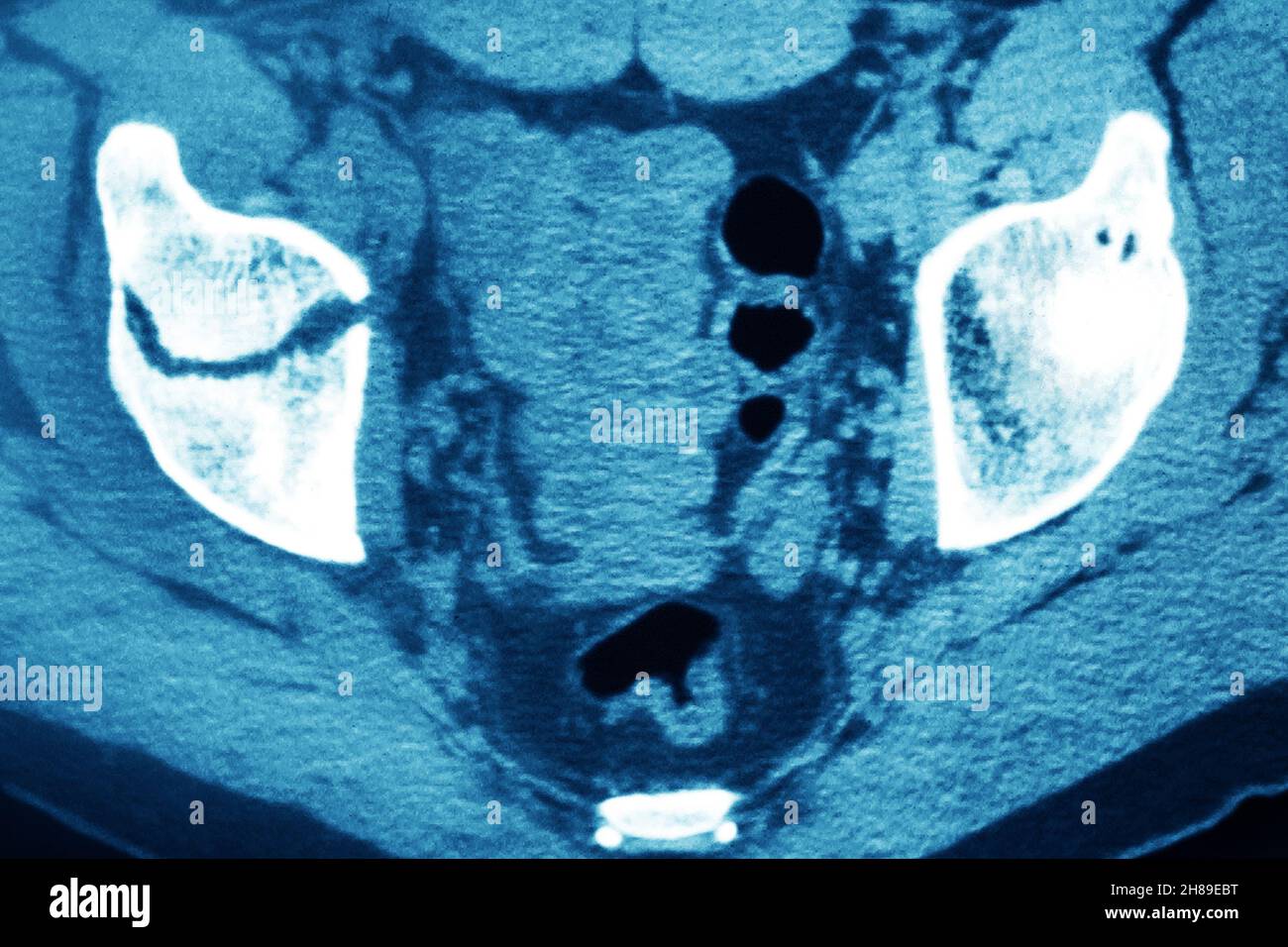 Pelvic fracture scan hi-res stock photography and images - Alamy