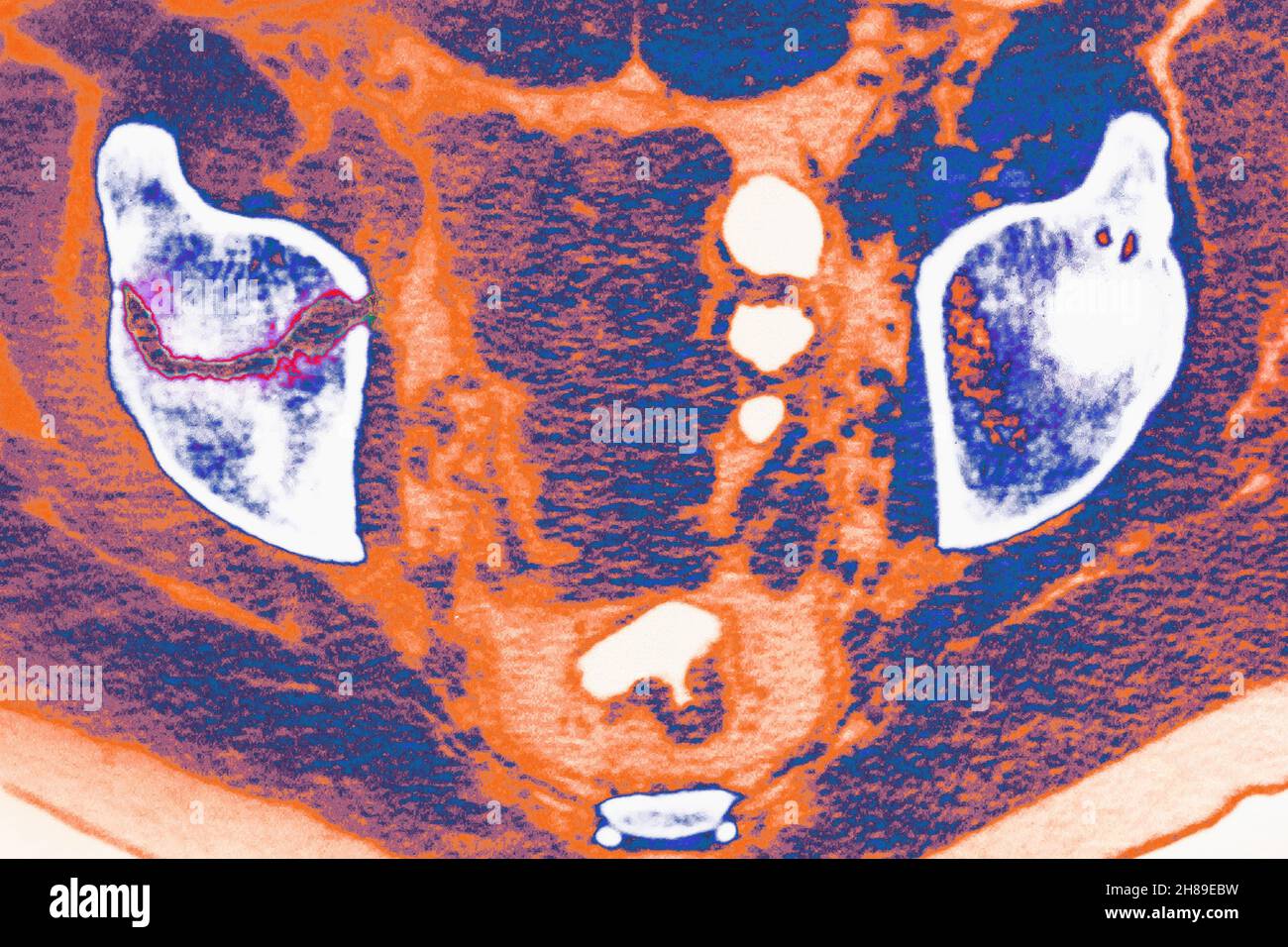 Pelvic fracture scan hi-res stock photography and images - Alamy