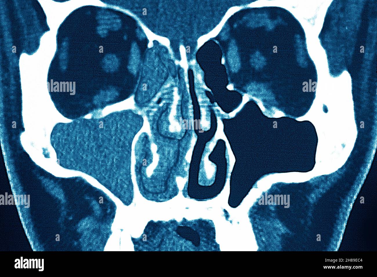 Ct scan sinuses hi-res stock photography and images - Alamy