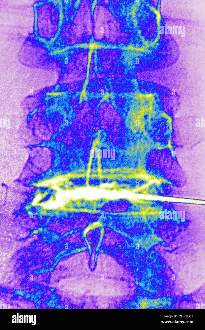 Spinal infiltration hi-res stock photography and images - Alamy