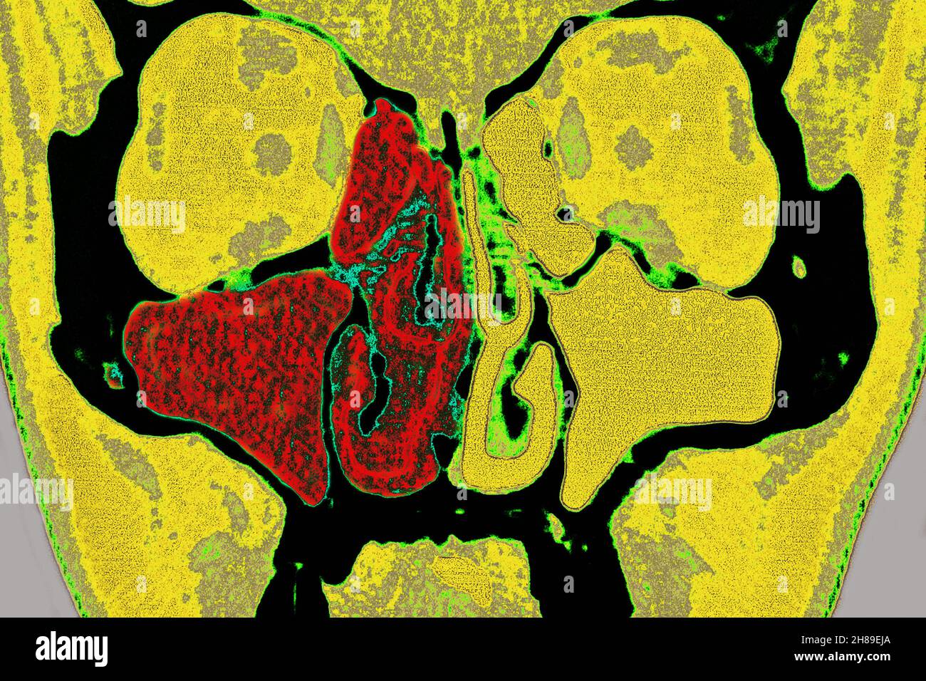 Sinus ct scan hi-res stock photography and images - Alamy