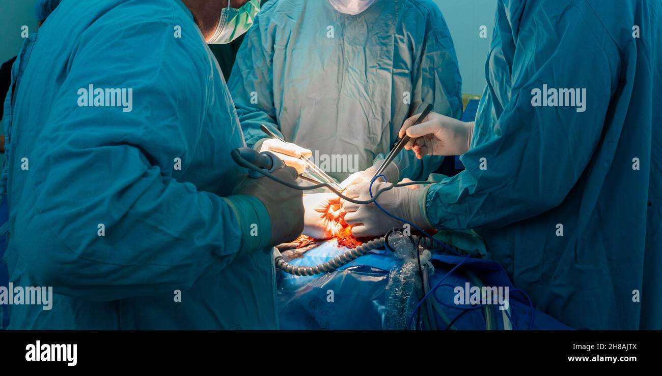 Neoplasm removal hi-res stock photography and images - Alamy