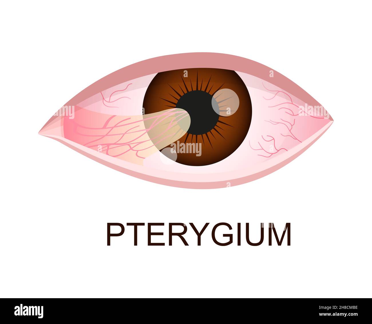 Conjunctival degeneration Stock Vector Images - Alamy