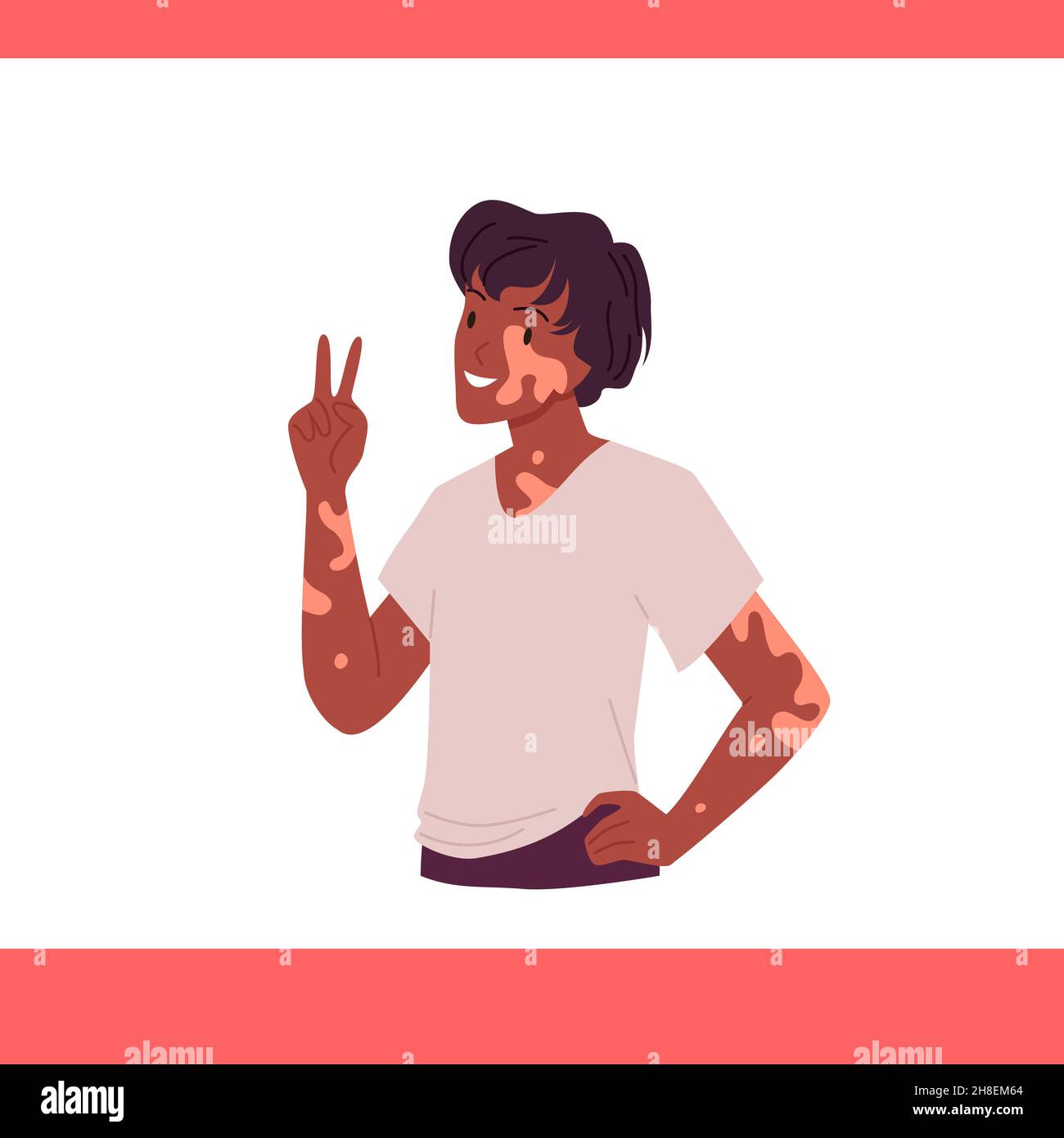 Man with vitiligo and skin depigmentation problem, funny guy showing ...