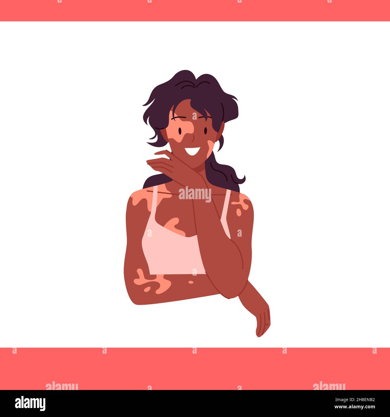 Girl with vitiligo smiling, young woman with different shape of ...