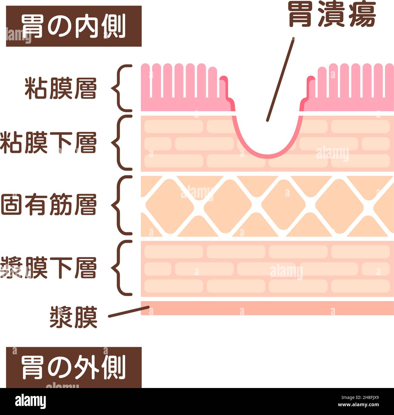 Sectional view illustration of gastric ulser Stock Vector Image & Art ...