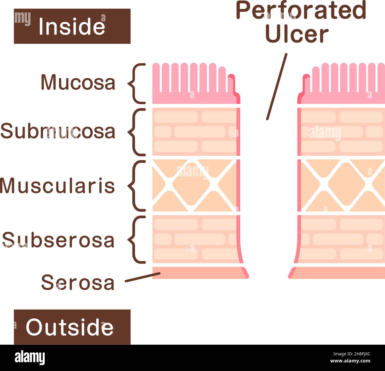 Sectional view illustration of perforated ulcer Stock Vector Image ...