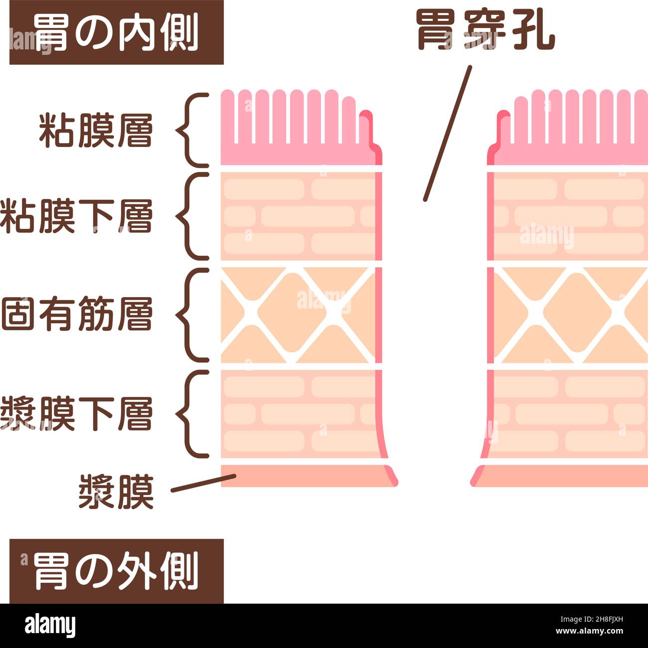 Sectional view illustration of perforated ulcer Stock Vector Image ...