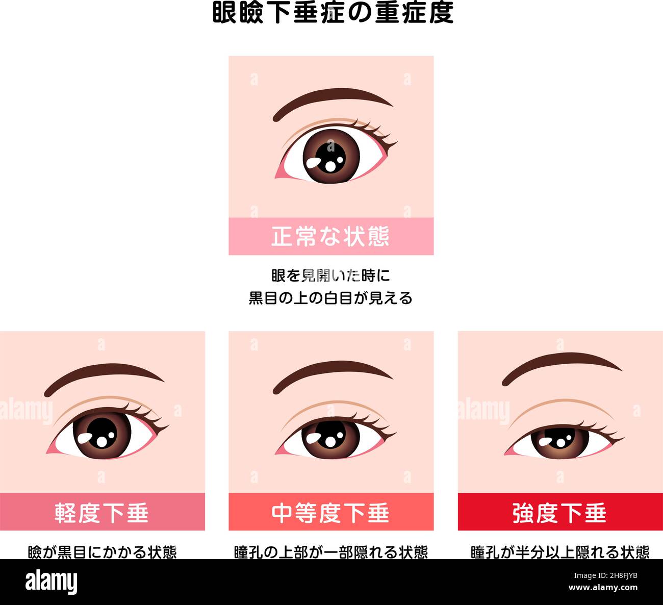 Grading In Ptosis Vector Illustration Stock Vector Image And Art Alamy