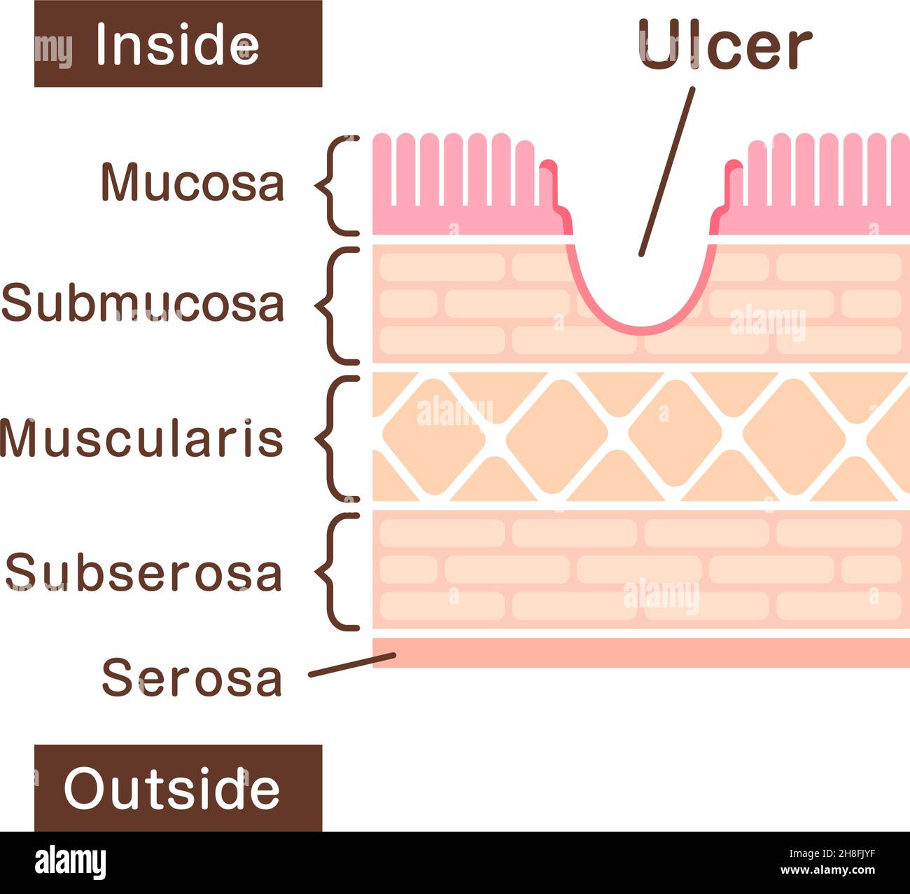 Sectional view illustration of gastric ulser Stock Vector Image & Art ...