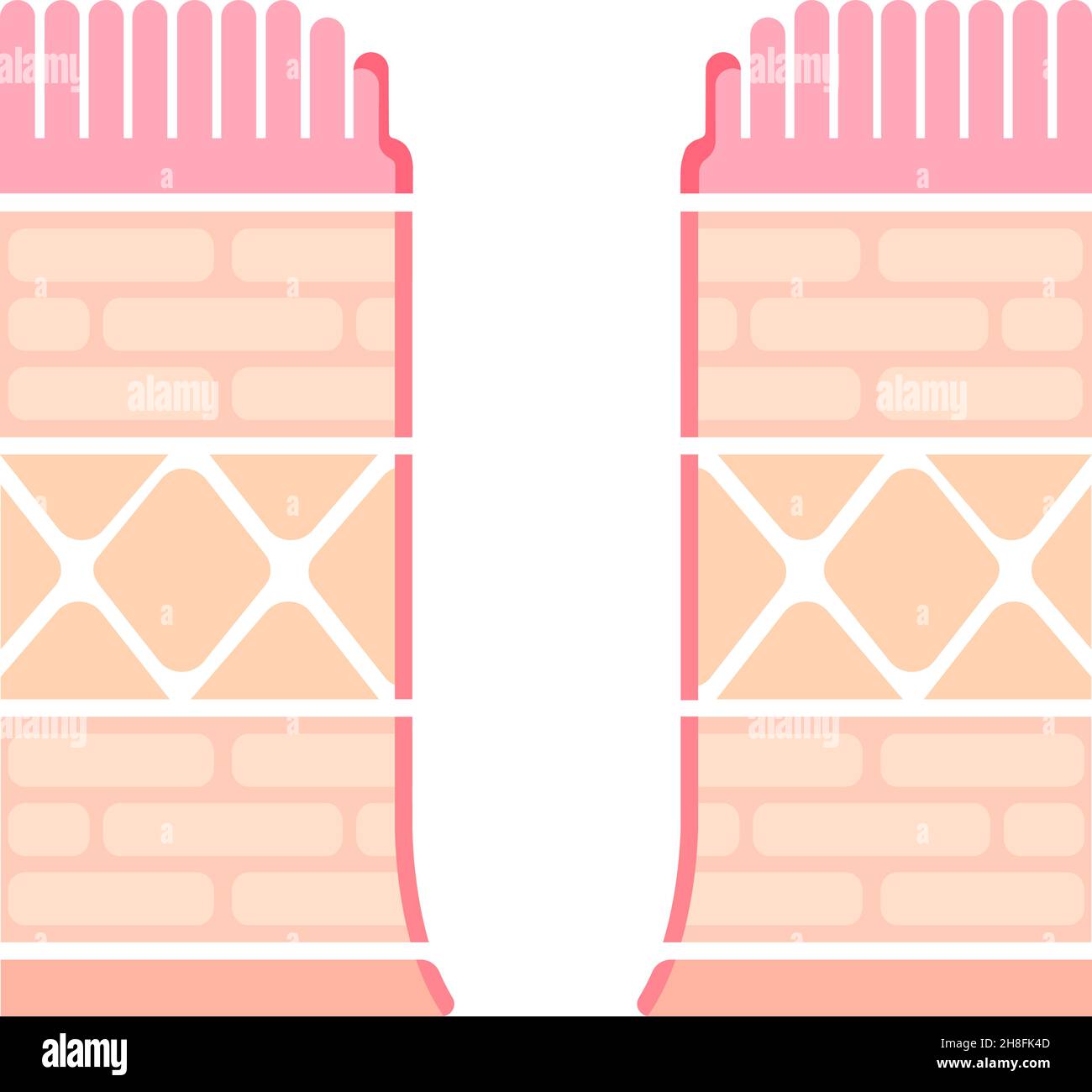 Sectional view illustration of perforated ulcer Stock Vector Image ...
