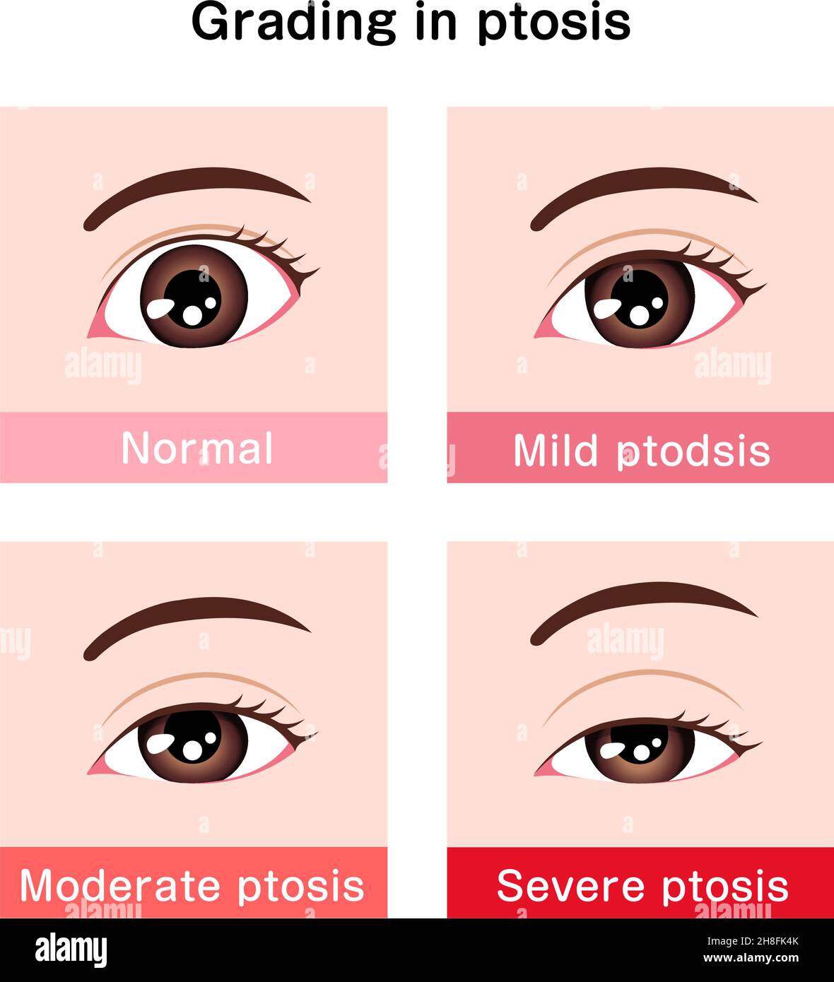 Grading in ptosis vector illustration Stock Vector Image & Art - Alamy