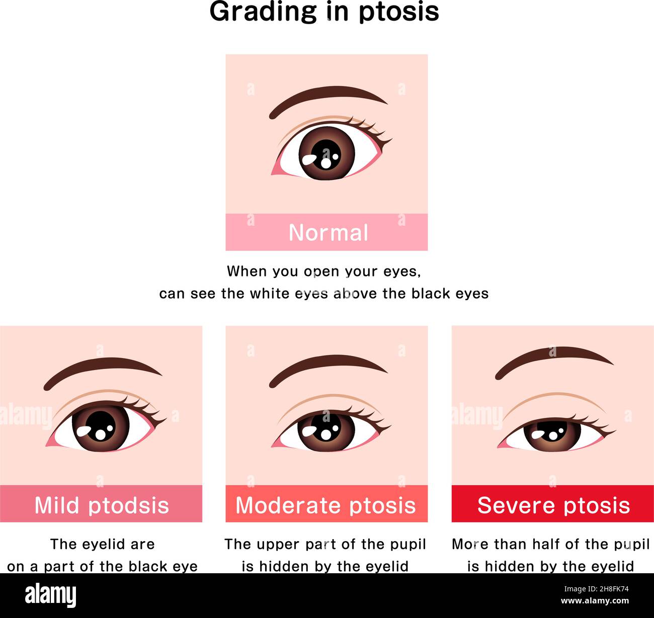 Eyelid Ptosis Cut Out Stock Images And Pictures Alamy