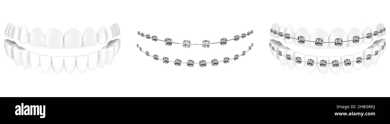 Teeth with or without braces. Arch braces without teeth. Orthodontic ...