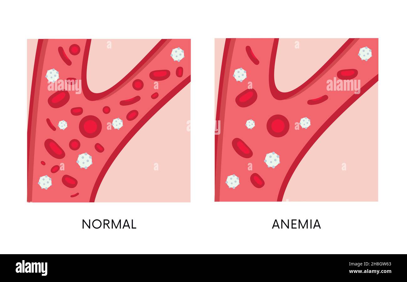 Normal and anemia amount of red blood cells in blood flat illustration ...