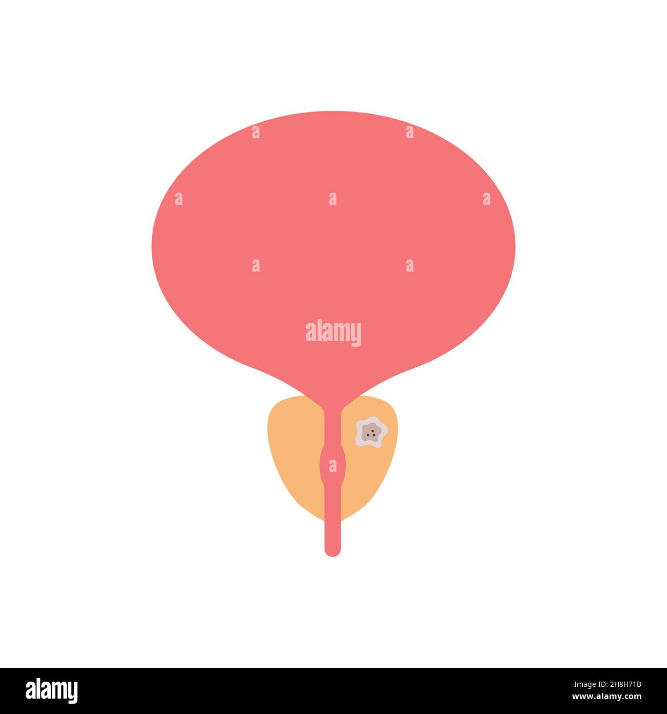 Prostate cancer flat illustration. Bladder, infertility, prostatitis ...