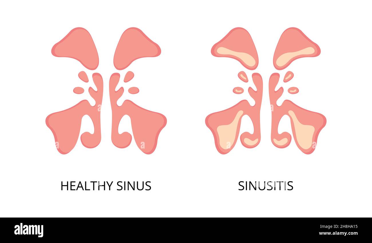 Healthy sinus and sinusitis flat image. Infection, inflammation, nasal ...