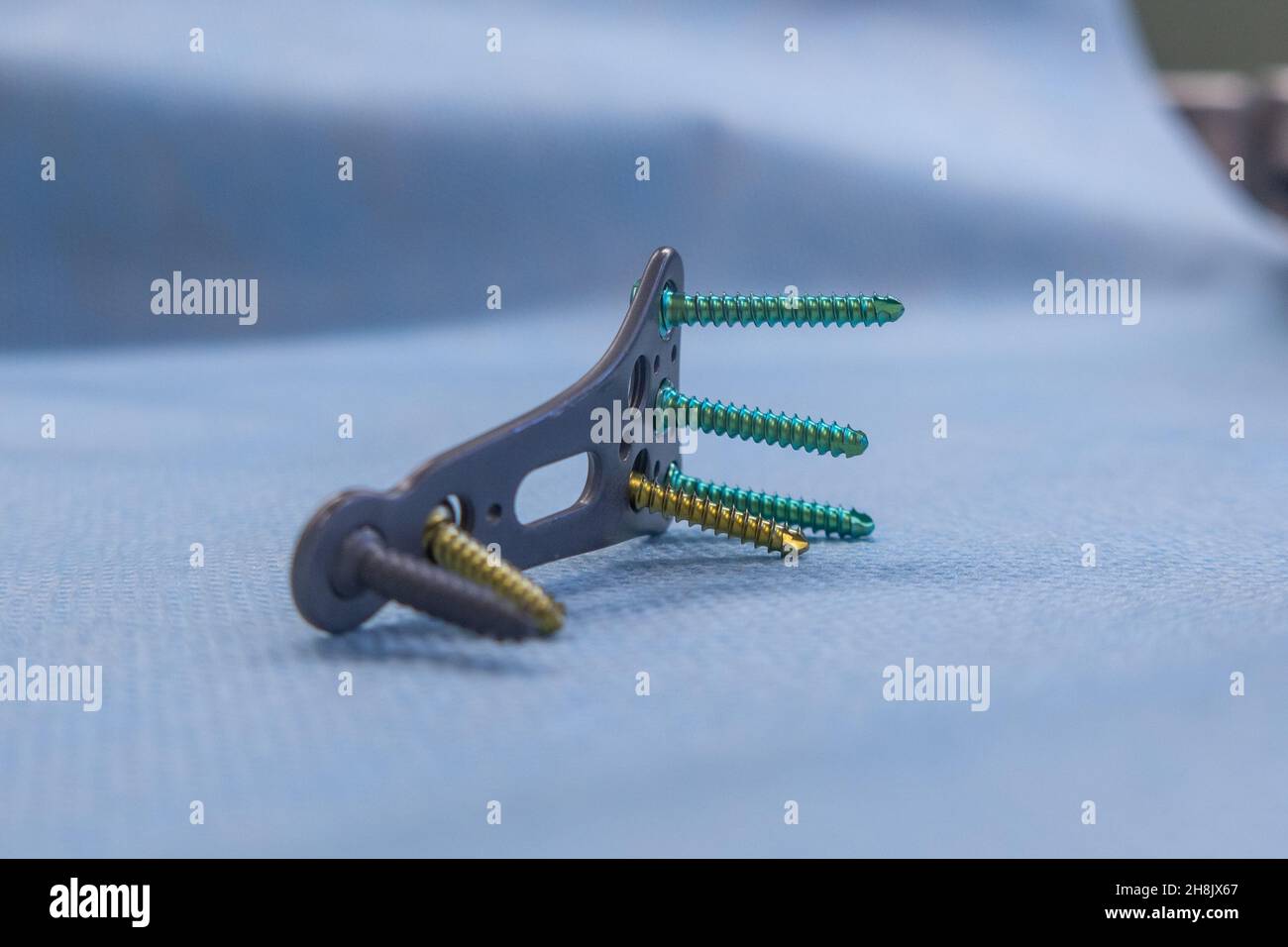 explanted titanium plate and various titanium screws of a radius ...