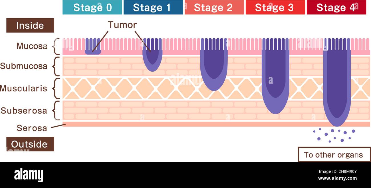 Stages of stomach cancer (gastric cancer) . Vector illustration Stock ...