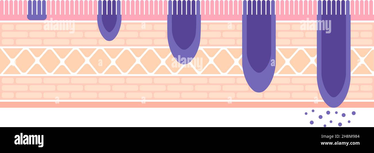 Cancer of esophagus Stock Vector Images - Alamy