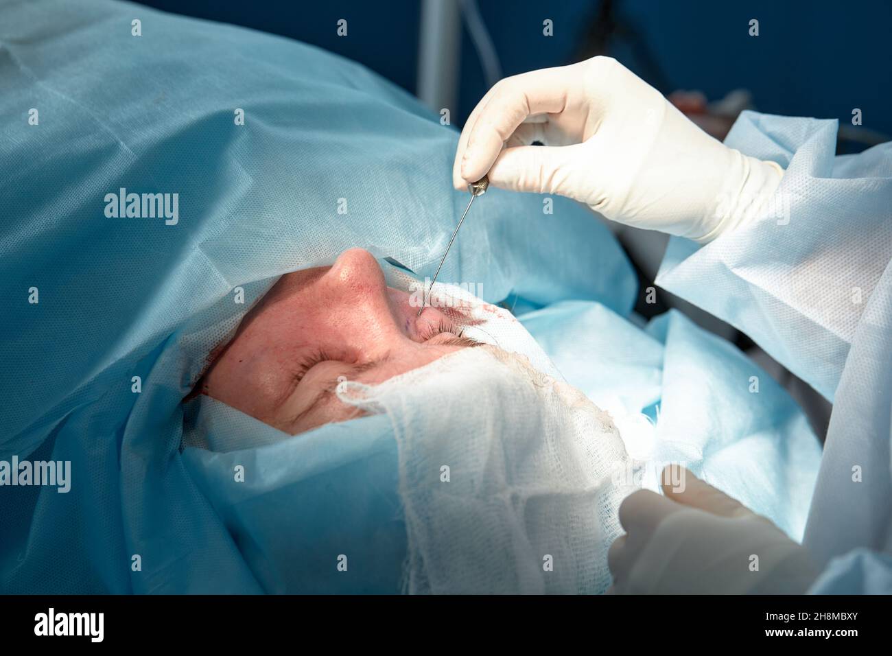 Close up of the face of a patient who is undergoing blepharoplasty. The ...